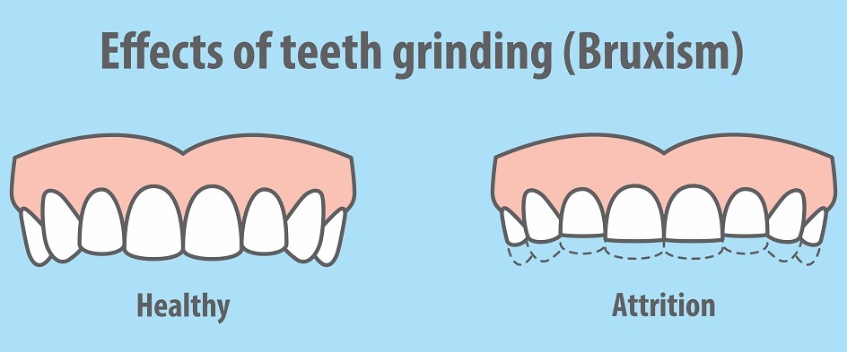 Treat Your Bruxism With Bite Splints (Grinding & Clenching of Teeth)