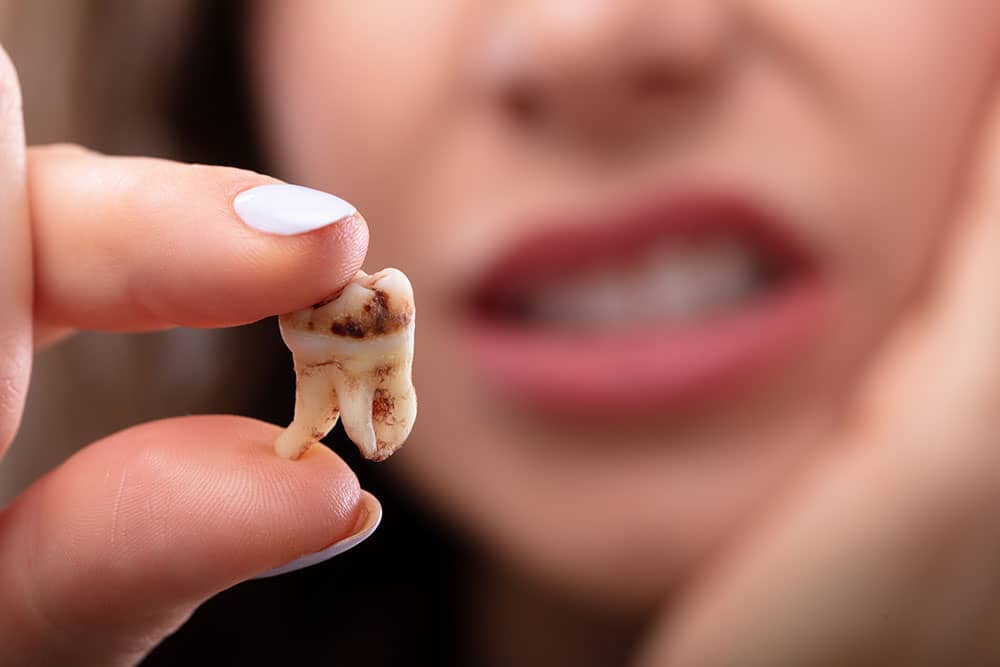 A Guide To Understanding Cavities And How To Prevent Them A Guide To Understanding Cavities And How To Prevent Them