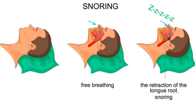 Snoring Appliances - We Have a Range of Options at 123 Dental