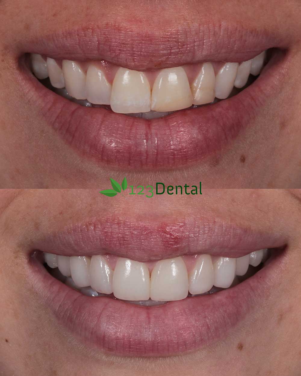 Expert Veneers Guide 2026: Costs, Types, Pros and Cons